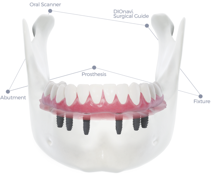DIO Navi - DIOimplant.LV