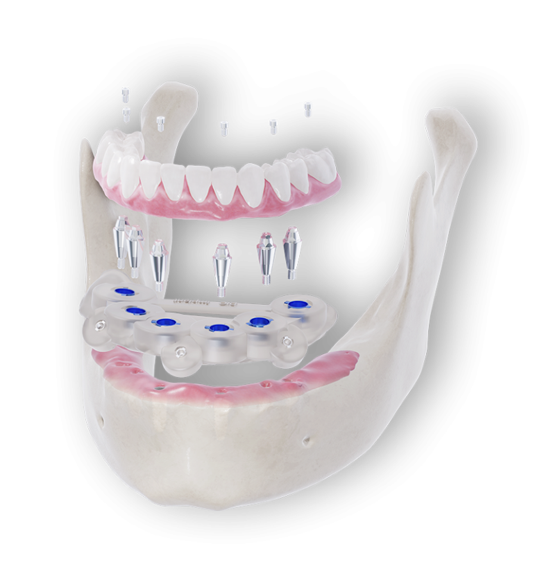 DIO Navi - DIOimplant.LV